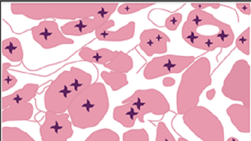 Ninja Star Nucleus in Dilated cardiomyopathy - Dr. Deepak Marwah